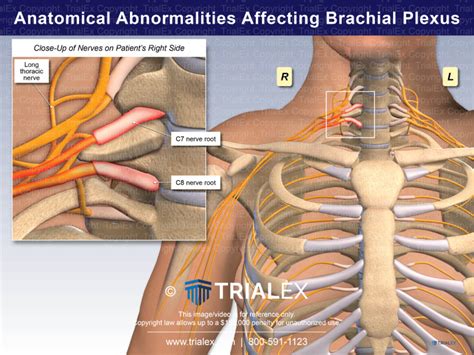 Patient S Abnormalities Affecting Brachial Plexus TrialQuest In