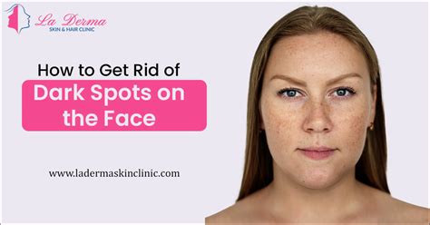 How To Get Rid Of Dark Spots On The Face La Derma Clinic