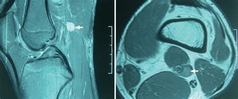 10 Fascinating Facts About Popliteal Lymph Nodes