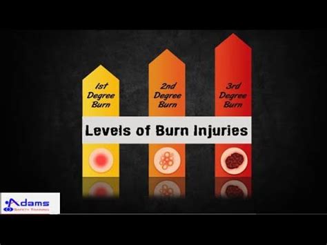 Understanding Burn Injuries Burn Injury Burns Injury