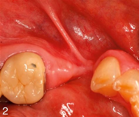 Materials And Methods Customized Titanium Lattice Structure