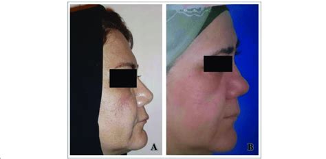 Medpor Insertion As Dorsal Graft For Reconstruction Of Mild Saddle Nose