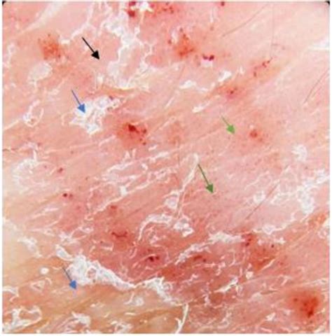 Dermoscopic Examination There Were Light Pink Backgrounds Black Download Scientific Diagram