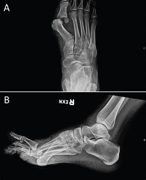 1st Metatarsal Head Foot