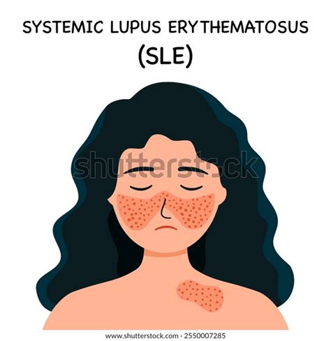 Systemic Lupus Erythematosus Girl Typical Butterfly Stock Vector