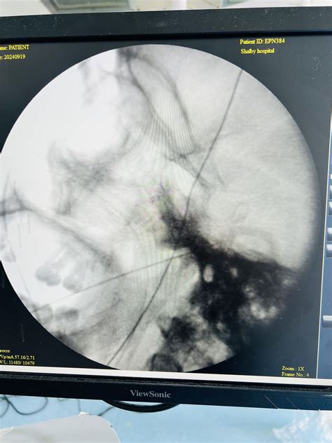 Anshul Agrawal On Linkedin Trigeminal Trigeminalballon Trigeminaltreatment