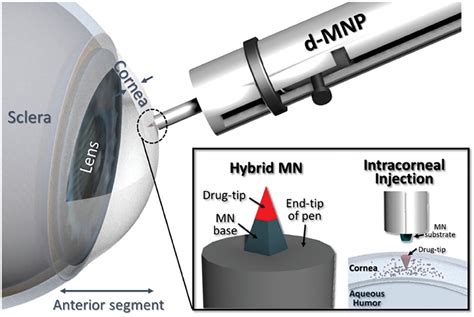 Implantable Microarray Patch Engineering At The Nano And Macro Scale