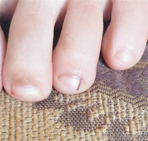 ظهور خط اسود في ظفر القدم لابنتي وعمرها سنوات من شهر تقريبا الطبي