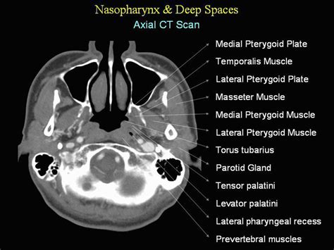 Nasopharynx Ct Internet Scientific Publications