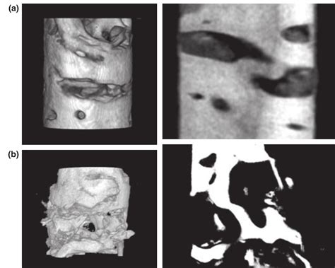 Mandibular Bone Anterior A And Posterior B Mandibular
