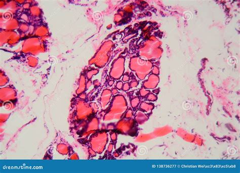 Human Thyroid Gland With Goiter Caused By Deficiency Of Iodine Under A Microscope Royalty Free