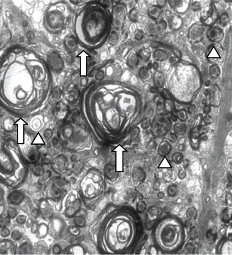 Myelin Content Within The Optic Nerve Ad Mbp Labeling Green Two Download Scientific