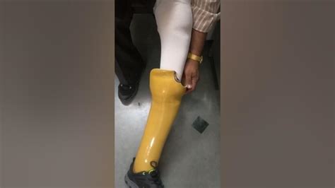 Symes Prosthesis Youtube