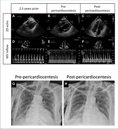 Pericardial Decompression Syndrome After Drainage Of Chronic