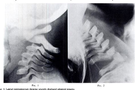 Structure Of Odontoid Process Of Axis Semantic Scholar
