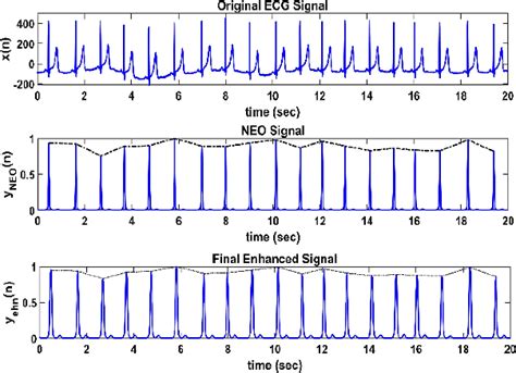 table vii from robust arrhythmia classification based on qrs detection