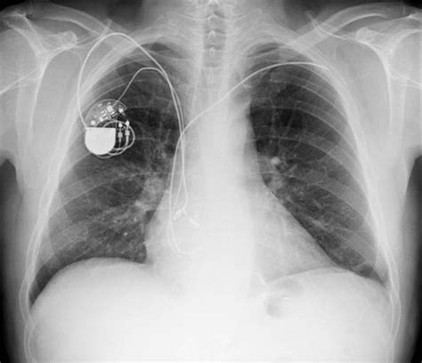 Ai Can Improve Xray Identification Of Pacemakers In
