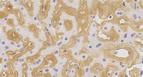 Periorbital Purpura Raccoons Eyes Pmc