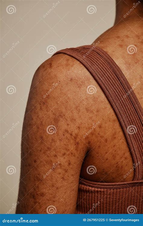 Dry Scars On The Back Of An Old Woman Tan Separately On A White