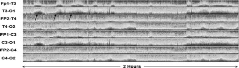 Density Spectral Array For Seizure Identification In Critica