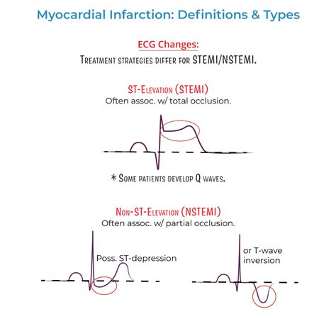 Clinical Pathology Glossary Myocardial Infarctions Types Definitions Ditki Medical