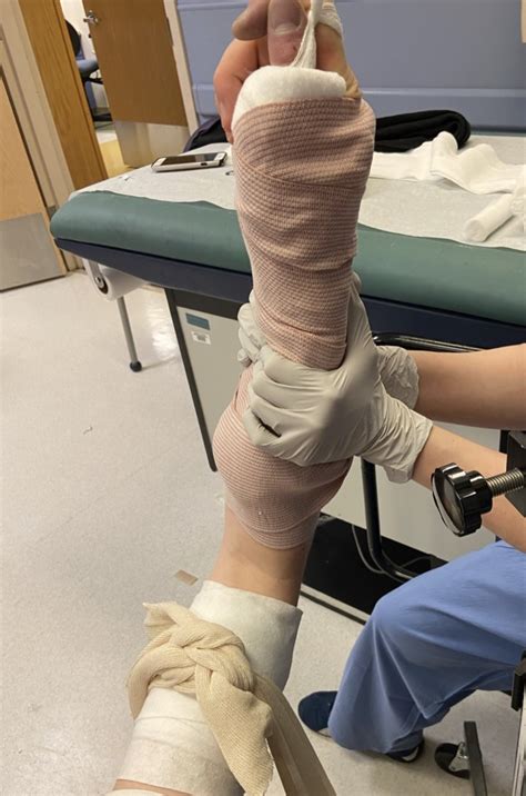 Hcorp Dorsal Volar Forearm Splint