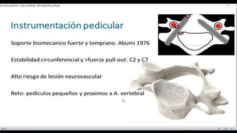 Instrumentación de la columna cervical subaxial - YouTube
