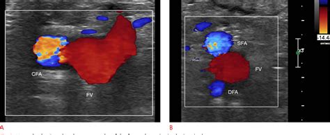 Pdf Doppler Ultrasonography Of The Lower Extremity Arteries Anatomy