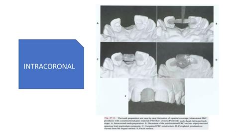 Fiber Reinforced Composite Fixed Prosthesis Pptx