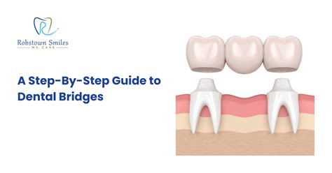 Dental Bridge Procedure Step By Step At Charles Nunnally Blog