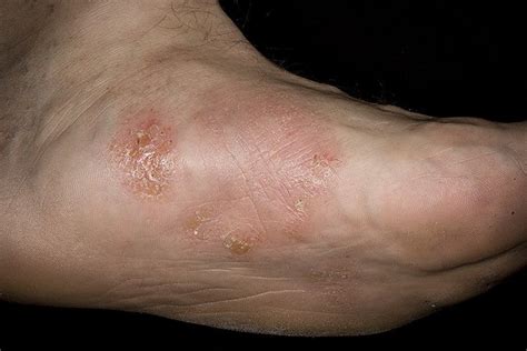 Экзема на ногах фото 186 шт
