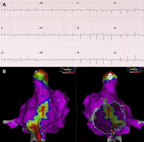 A A 12 Lead Electrocardiogram Showing Typical Counterclockwise Atrial Download Scientific