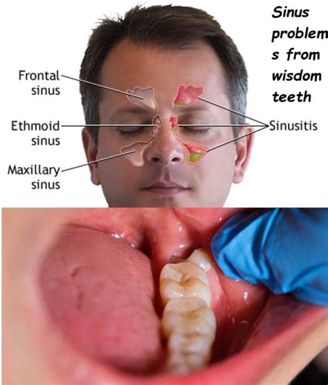 Sinus Problems From Wisdom Teeth Dr Haroon Dental Specialist Clinic