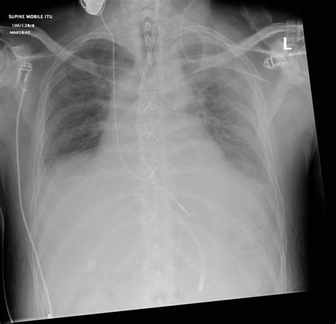 Central Venous Catheter Subclavian