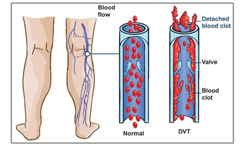 The Difference Between Dvt And Ehit Deep Vein Thrombosis