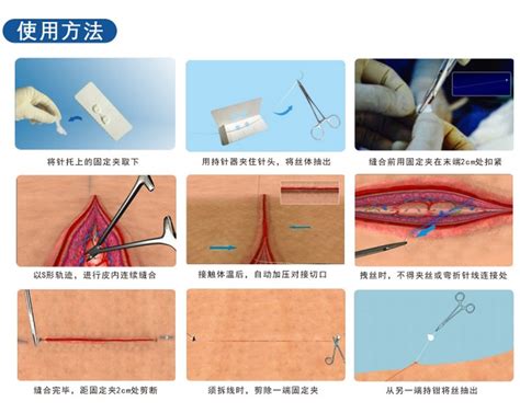 带针钛镍记忆合金缝合线（钛镍记忆合金组织吻合器）生产厂家博宇招商代理环球医疗器械网