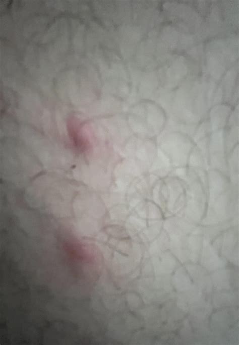 Bug Bites R Bugbites