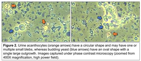 Urine Sediment Of The Month Dysmorphic Red Blood Cells Blebs Spikes Renal Fellow Network