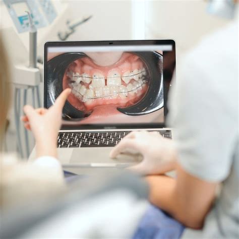 Made Of High Performing Triangular Shaped Brackets Fastbraces Qualify