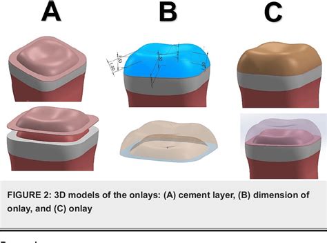 Figure 2 From Three Dimensional Finite Element Analysis Of Worn Molars
