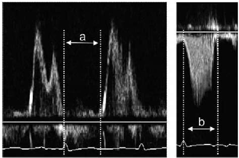 figure 1 from use of myocardial performance index in pediatric patients