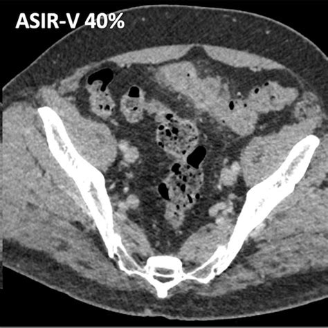 reconstruction algorithms ct images 0 625 mm slice thickness in a