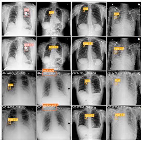 Chest X Ray Foreign Objects Detection Using Artificial Intelligence