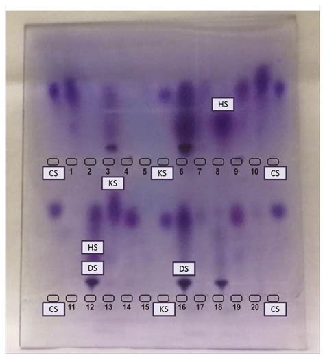 Diagnosis Of Mucopolysaccharidoses