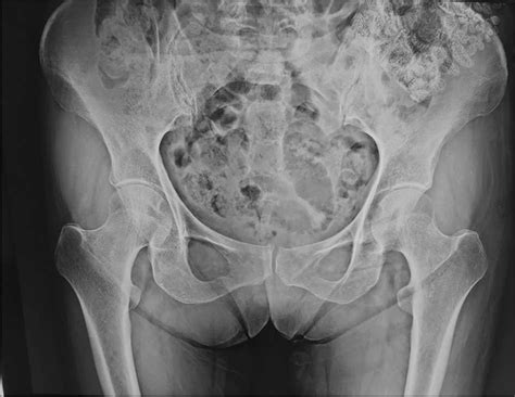 Ischial Bursitis Meded Cases