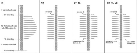 Schematic Representation Of Common Variations Of Vertebral Patterns And