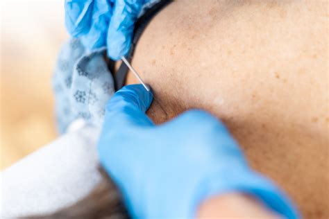 Trigger Point Dry Needling Dr Amy O Donnell Chiropractic Physician