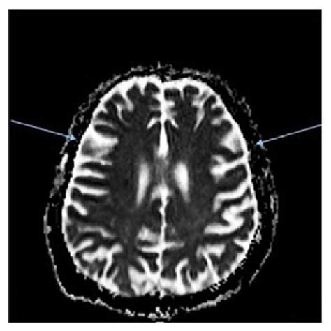 Mri Of Brain Showing Bifrontal And Periventricular Lesions Source