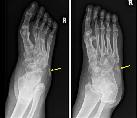 Myositis Ossificans Radiology Cases