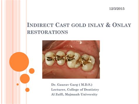 Cast Gold Inlay And Onlay Restorations A Dental Overview